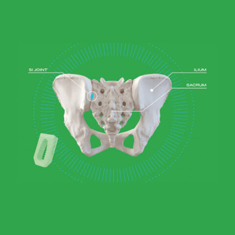 LinQ™ Sacroiliac Joint Fusion by PainTEQ | Louisiana Pain Specialists