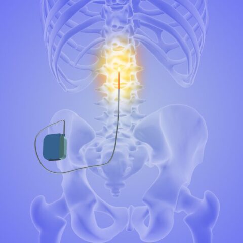 Spinal Cord Stimulator Implant – Trial Procedure | Louisiana Pain ...